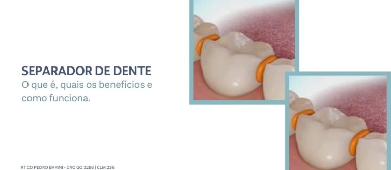 Separador de Dente – O que é, quais os benefícios e como funciona ...
