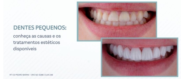 Dentes pequenos: conheça as causas e os tratamentos estéticos ...