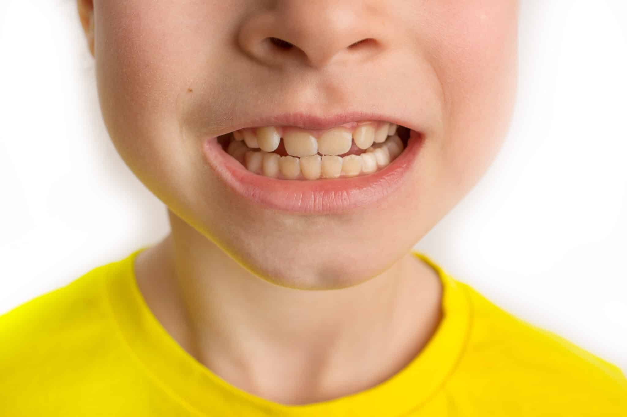 Mordida cruzada: entenda o que é, causas, tipos e tratamentos! – Barini ...