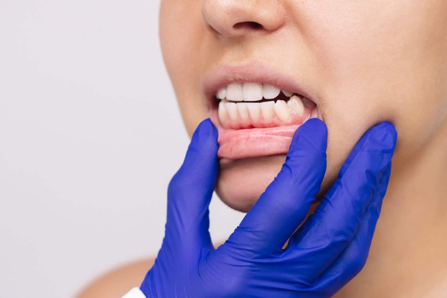 Mordida cruzada: entenda o que é, causas, tipos e tratamentos! – Barini ...